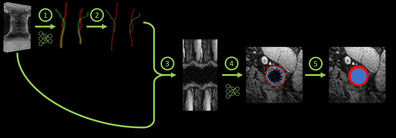 Carotid Artery Vessel Wall Segmentation Team Wall E Algorithms Grand Challenge